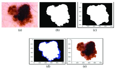 segmentation of the dermoscopic image by the proposed method a download scientific diagram