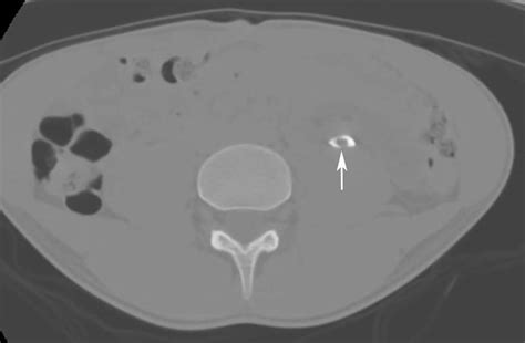 Fibroepithelial Polyp An Axial Excretory Phase Contrast Enhanced Ct Download Scientific