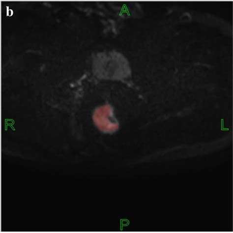 a c manual segmentation of rectal cancer in intravoxel incoherent