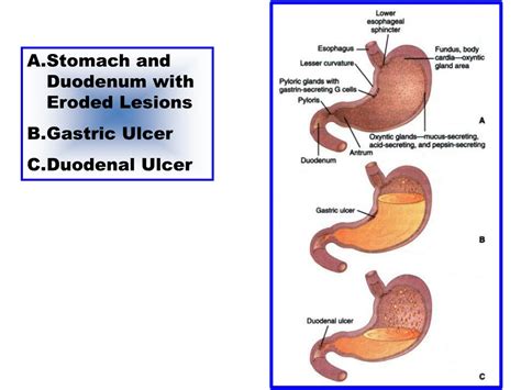 Ppt Medical Nutrition Therapy For Gastrointestinal Tract Disorders