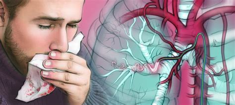 Bronchial Artery Embolization — The Interventional Initiative