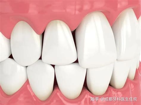 牙齿上的黑三角应该如何治疗 知乎
