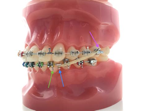 Class Iii Elastics About Braces