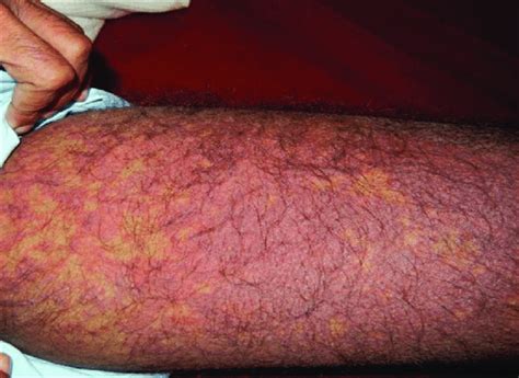 Erythematous Maculopapular Rash Over Thigh Download Scientific Diagram