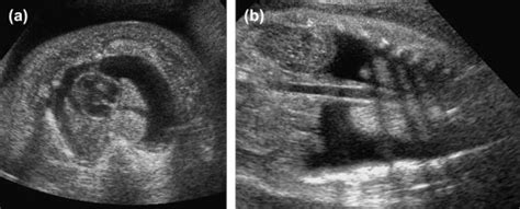 Fetal Pleural Effusion Treatment In Pune Dr Tejas Tamhane