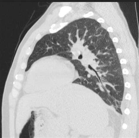 000 Subsegmental Bronchi Anatomy The Common Vein