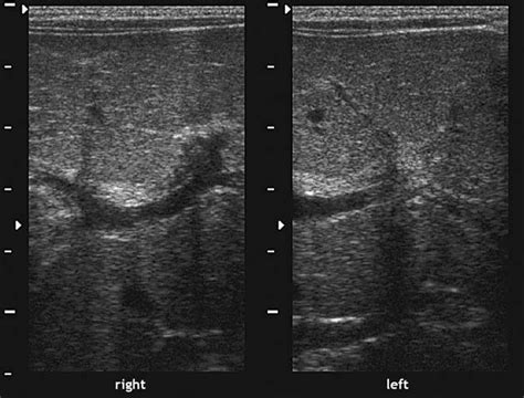 Triangular Cord Sign On First And Second Order Branches Download Scientific Diagram