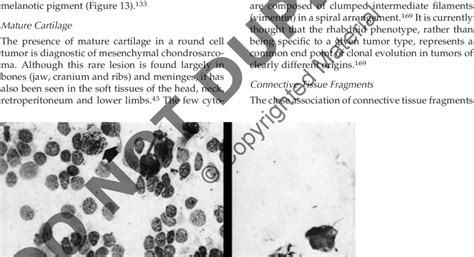 Melanotic Neuroectodermal Tumor Of Infancy A Smears Containing Download Scientific Diagram