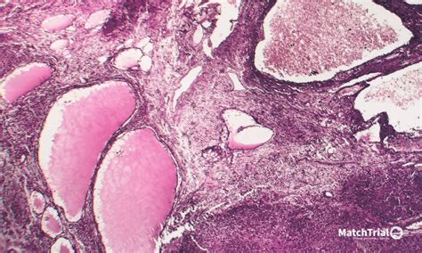 ¿qué Es El Tnm O Estadiaje Del Tumor Matchtrial