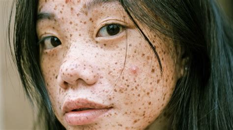 Як прибрати пігментні плями на обличчі поради Здоровя