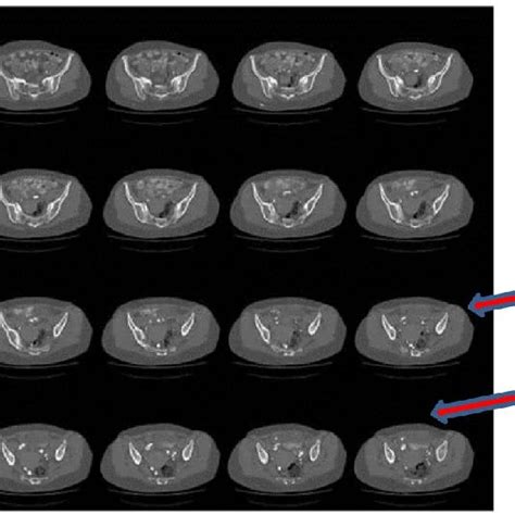 Ct Scans Show Multiple Calcifications In The Abdomen And Pelvis