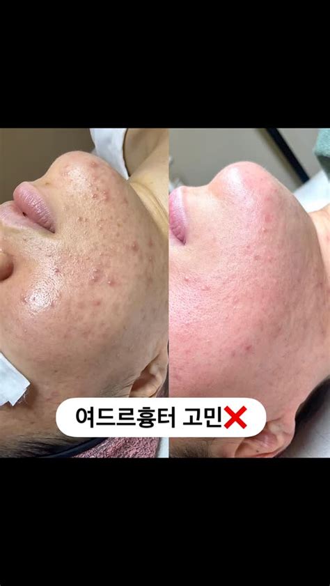 라뽀스파 • 압출전문 • 여드름피부 •문제성피부 • 주사피부염 • 여드름흉터 • 지루성피부염 손상피부 피부장벽 피부복구 피부장벽은 피부를 외부 자극으로부터 보호하고