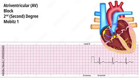 Second Degree Atrioventricular Block Mobitz 1 2nd Degree Av Block