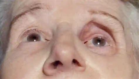 Enophthalmos Ars Neurochirurgica