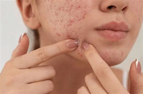 Achieving Clear Skin Strategies To Get Rid Of Facial Blemishes Mitmunk