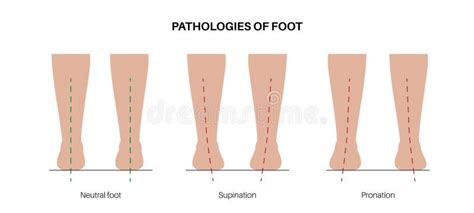 Underpronation
