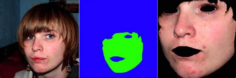 Table 1 From A Deep Learning Based Facial Acne Classification System Semantic Scholar