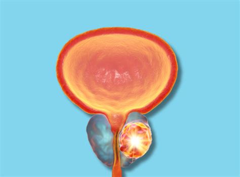 წინამდებარე ჯირკვლის ულტრაბგერითი კვლევა Solomed