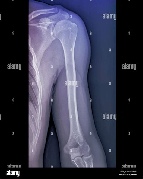 Normal Humerus X Ray