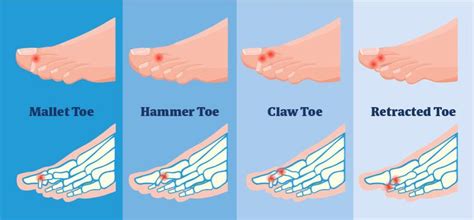 Pinky Toe Hammer Toe
