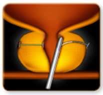 Urolift Procedure For Bph Urology Ucla Health