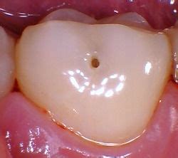 Cavity Fillings While Pregnant Yea Or Nay 1311 Jackson Ave Dental
