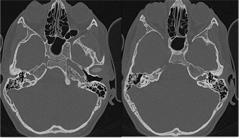 Cochlear Implantation In Incomplete Partition Type Iii Acta