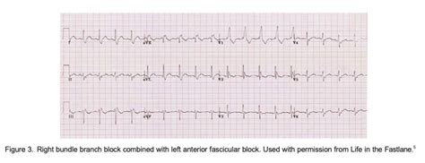 Subsection Basic Science Trifascicular Block Diagnosis And Anaesthetic Considerations Wfsa