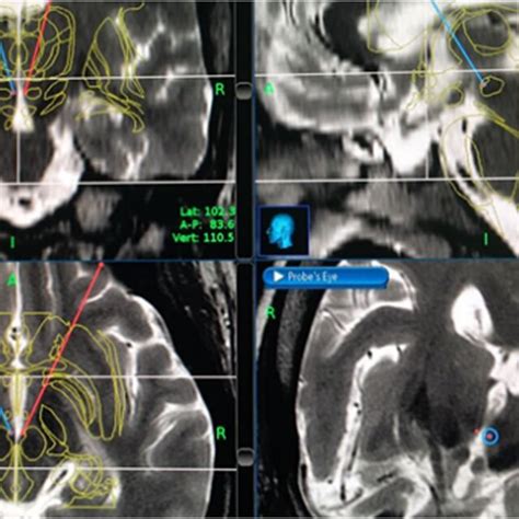 Tw1 Mri Ct‐s Intraop Fusion Showing Deep Brain Electrodes Implanted In Download Scientific