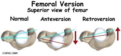 Femoral Anteversion
