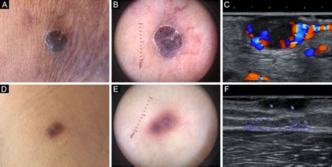 Dermoscopy And Ultrasonography Of Kaposis Sarcoma Nodules New Insights To Guide Intralesional