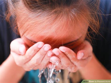 How Can We Prevent Acne Health News