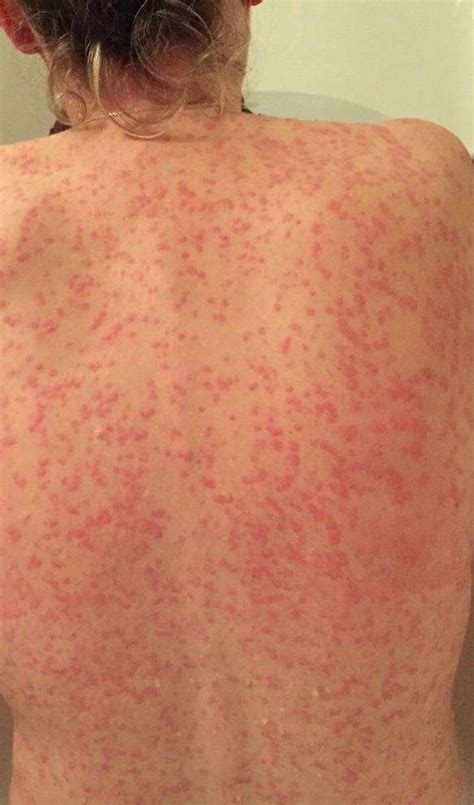 Life With Chronic Urticaria Artofit