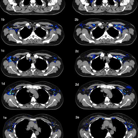 1ae Delineation Of Lymph Node Metastases Mln Outside Download Scientific Diagram