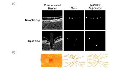 a segmentation network performance on an oct image with without an