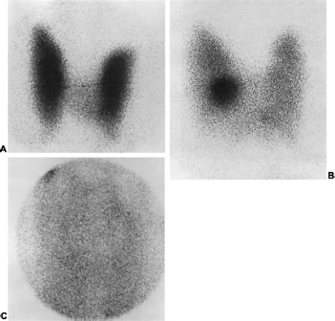 Differential Diagnosis Of Hyperthyroidism Oncohema Key