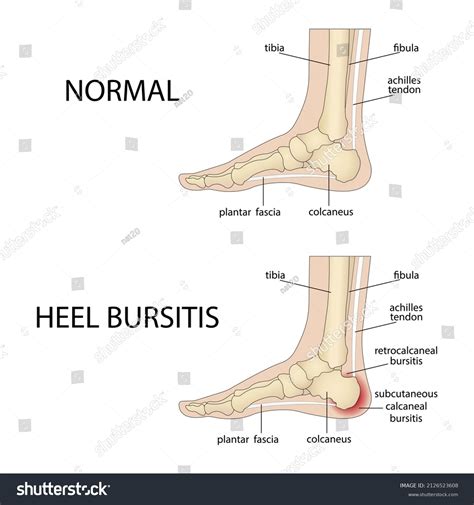 Calcaneal Bursitis Foot Normal Heel Foot Stock Vector Royalty Free