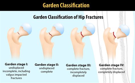 Em Didactic Proximal Femur Fractures