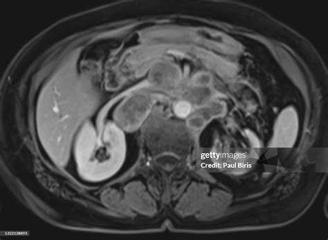 Enlarged Retroperitoneal Lymph Nodes Long Term Survival With Surgery
