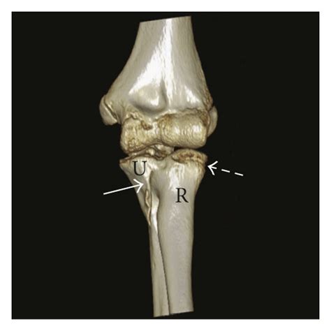 Left Elbow Ct Scans Ac And Ct 3d Reconstruction Df At Two Years Download Scientific