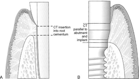 Soft Tissue Procedures Around Implants Pocket Dentistry