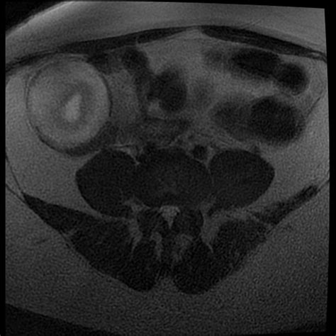 An Unusual Case Of Secondary Hypertension In 1st Trimester Fertility Assisted Pregnancy Eurorad