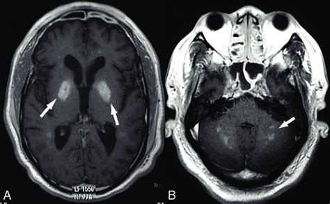 Patchy Punctate Postcontrast Enhancement Pattern With Consistent Small