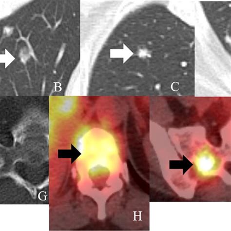 49 Year Old Female With Metastatic Intrahepatic Cholangiocarcinoma A Download Scientific