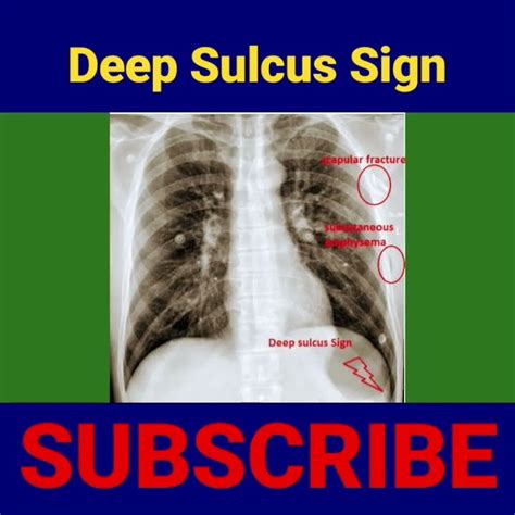 Deep Sulcus Sign Of Supine Pneumothorax Ruaue