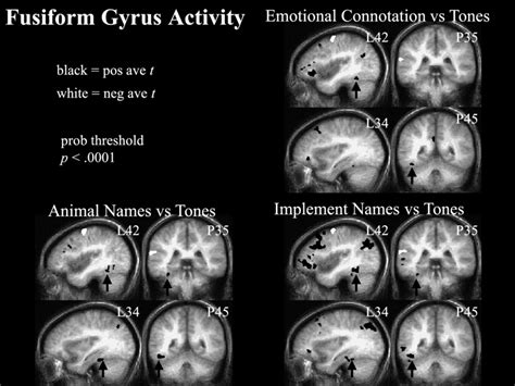 Significant Activity P 0001 In The Fusiform Gyrus Posterior Download Scientific Diagram