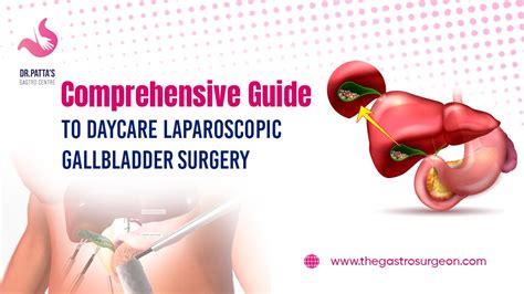 Daycare Laparoscopic Gallbladder Surgery Guide