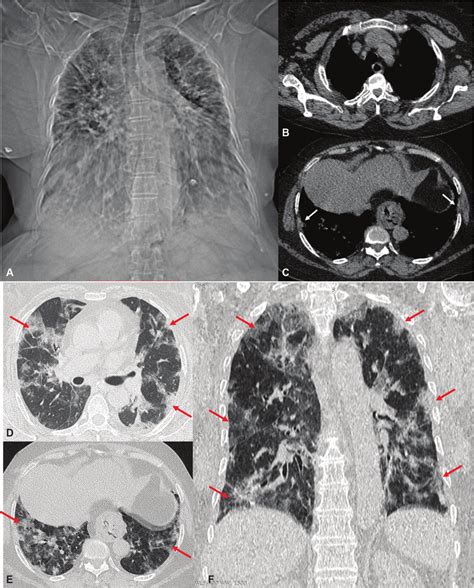 Computed Tomography Ct Of A 71 Year Old Female With Diabetes Download Scientific Diagram