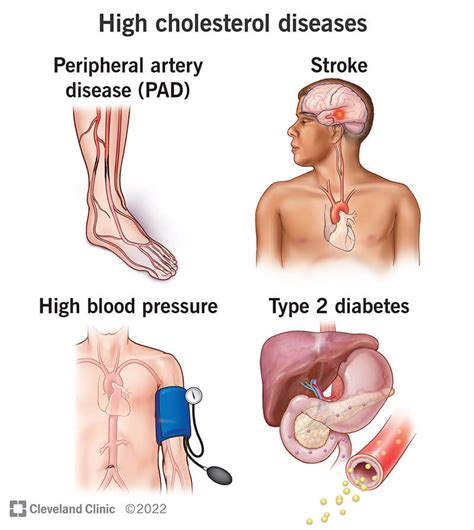 Causes Of High Cholesterol