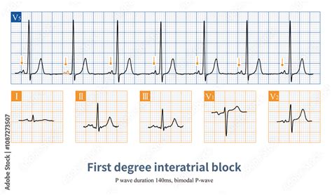 When The First Degree Interatrial Block Occurs The Conduction Time From The Right Atrium To The